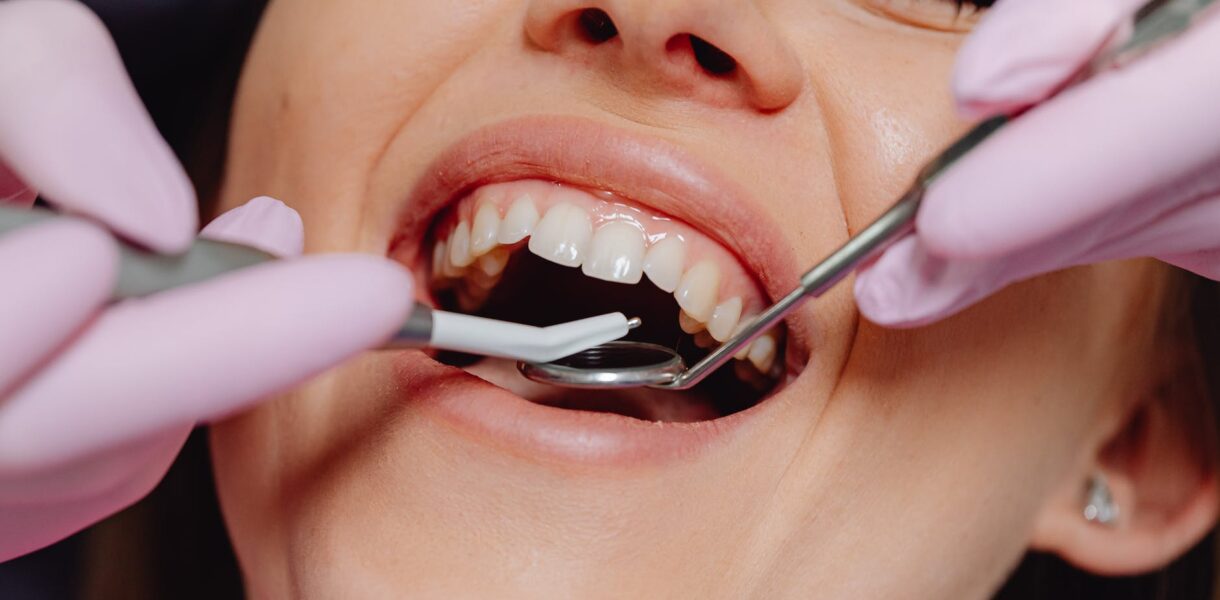 Gengive infiammate, quali sono le principali cause